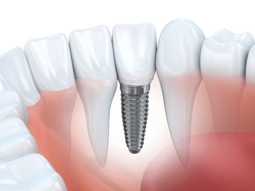 Looking After Your New Dental Implant | Dentist in Bucks - Dental Blog ...